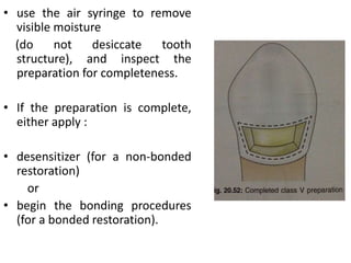 Class V and VI amalgam cavity preparations | PPTX