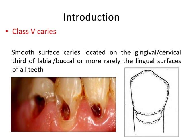 Class V and VI amalgam cavity preparations | PPTX