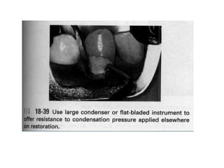 Class V and VI amalgam cavity preparations | PPTX