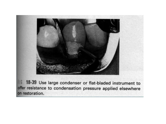 Class V and VI amalgam cavity preparations | PPTX