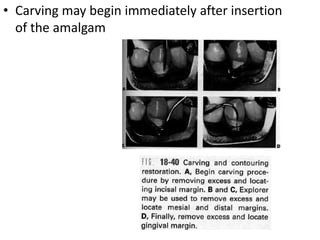 Class V and VI amalgam cavity preparations | PPTX
