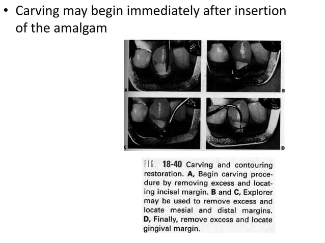 Class V and VI amalgam cavity preparations | PPTX