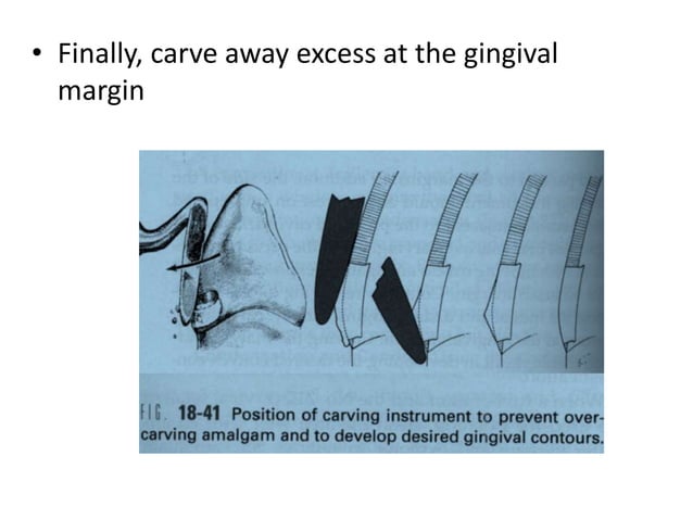 Class V and VI amalgam cavity preparations | PPTX
