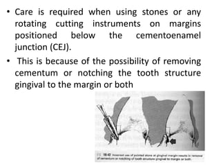 Class V and VI amalgam cavity preparations | PPTX