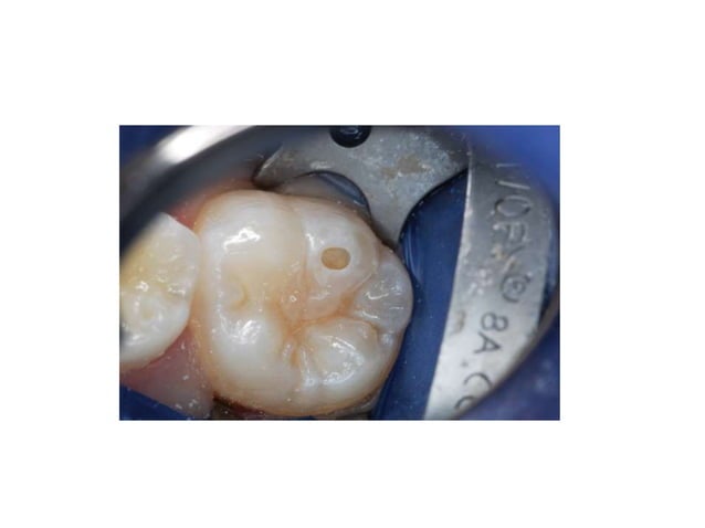 Class V and VI amalgam cavity preparations | PPTX