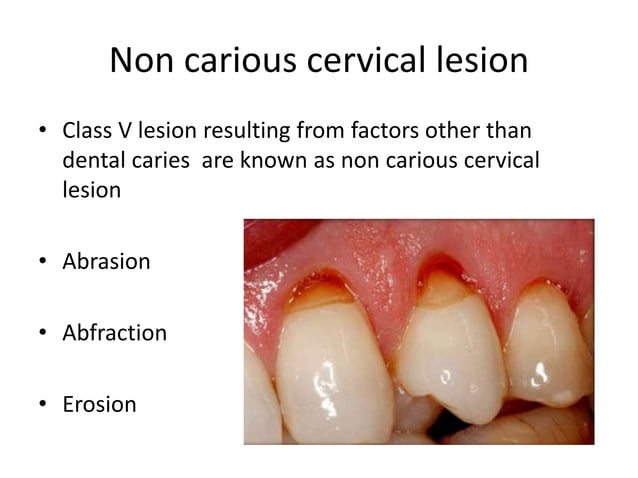 Class V And Vi Amalgam Cavity Preparations Pptx