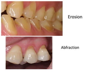 Class V and VI amalgam cavity preparations | PPTX