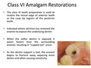 Class V and VI amalgam cavity preparations | PPT