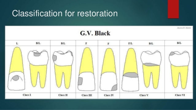 Classvcavitypreparationforamalgamrestorations-gate01