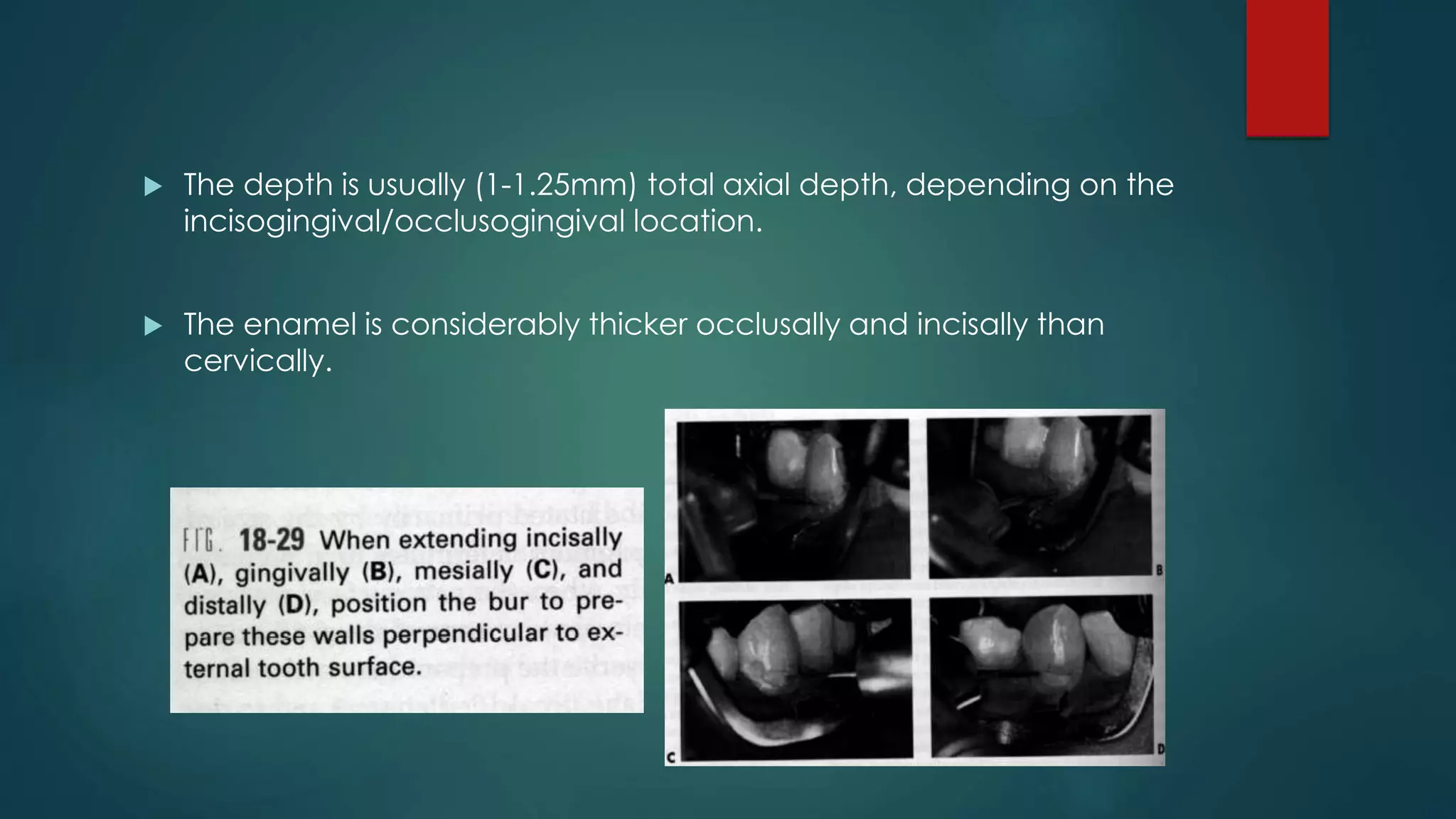 Class v tooth preparation for amalgam restorations | PPTX