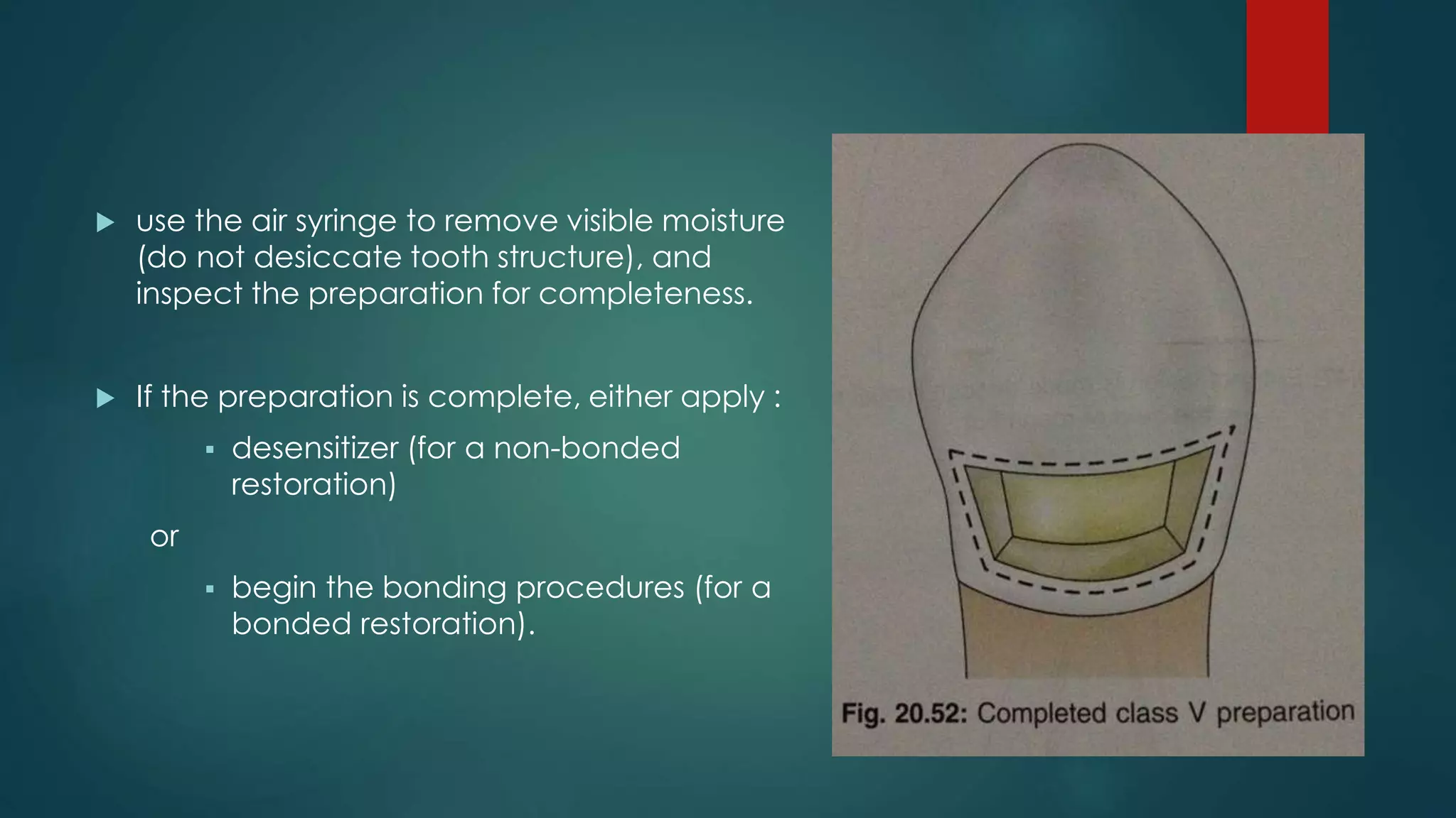 Class v tooth preparation for amalgam restorations | PPTX