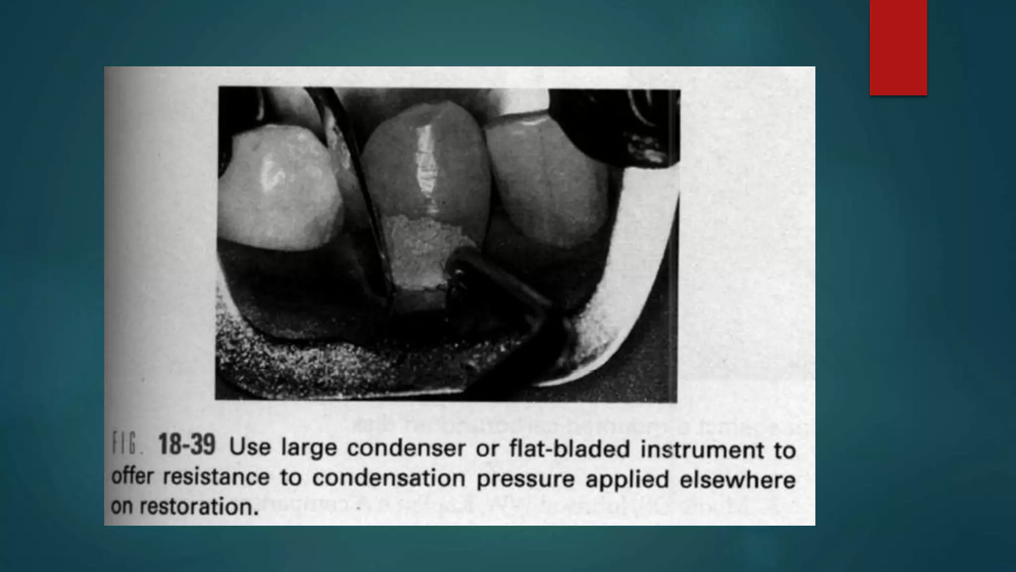 Class v tooth preparation for amalgam restorations | PPTX
