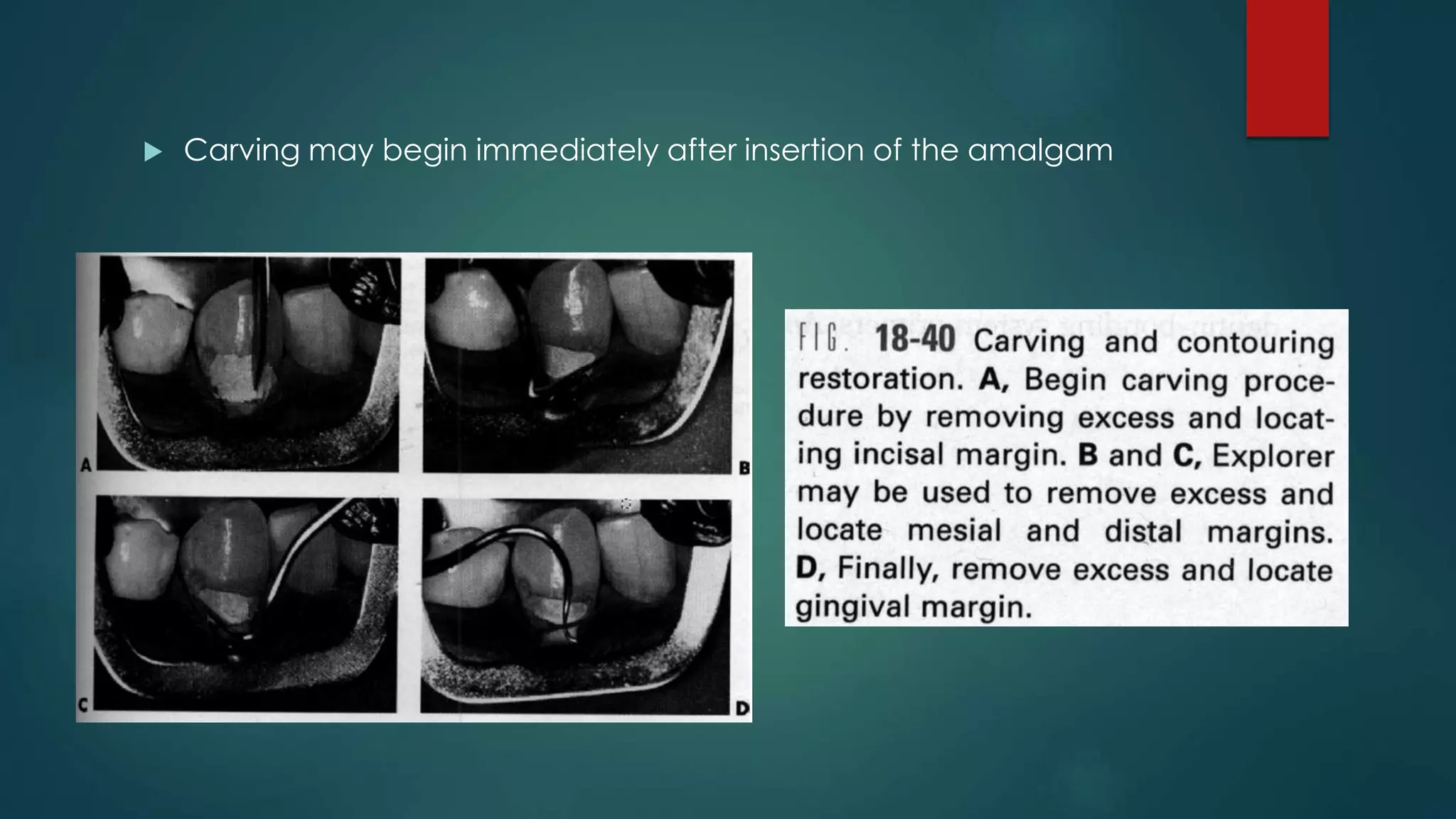 Class v tooth preparation for amalgam restorations | PPTX