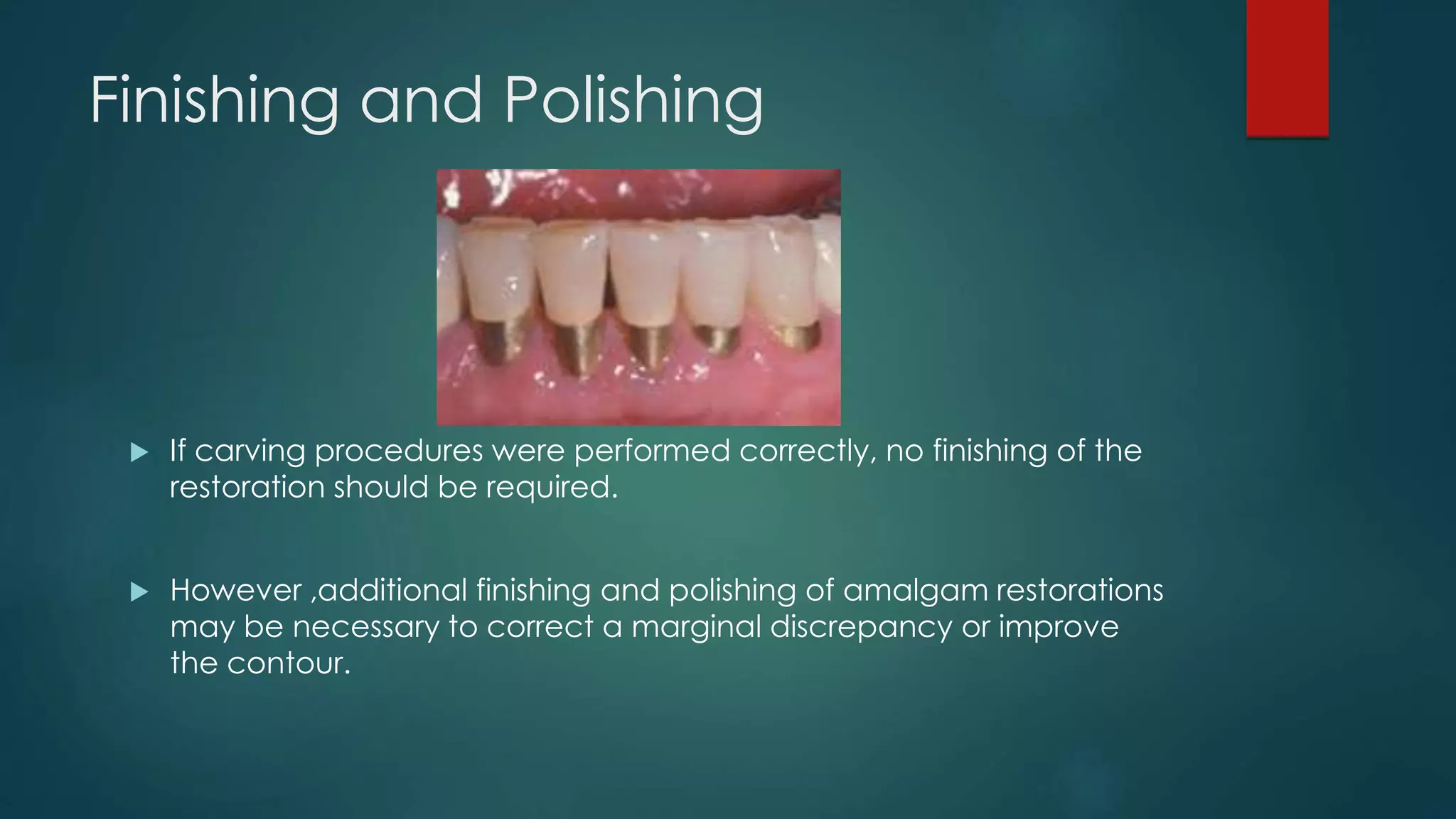 Class v tooth preparation for amalgam restorations | PPTX