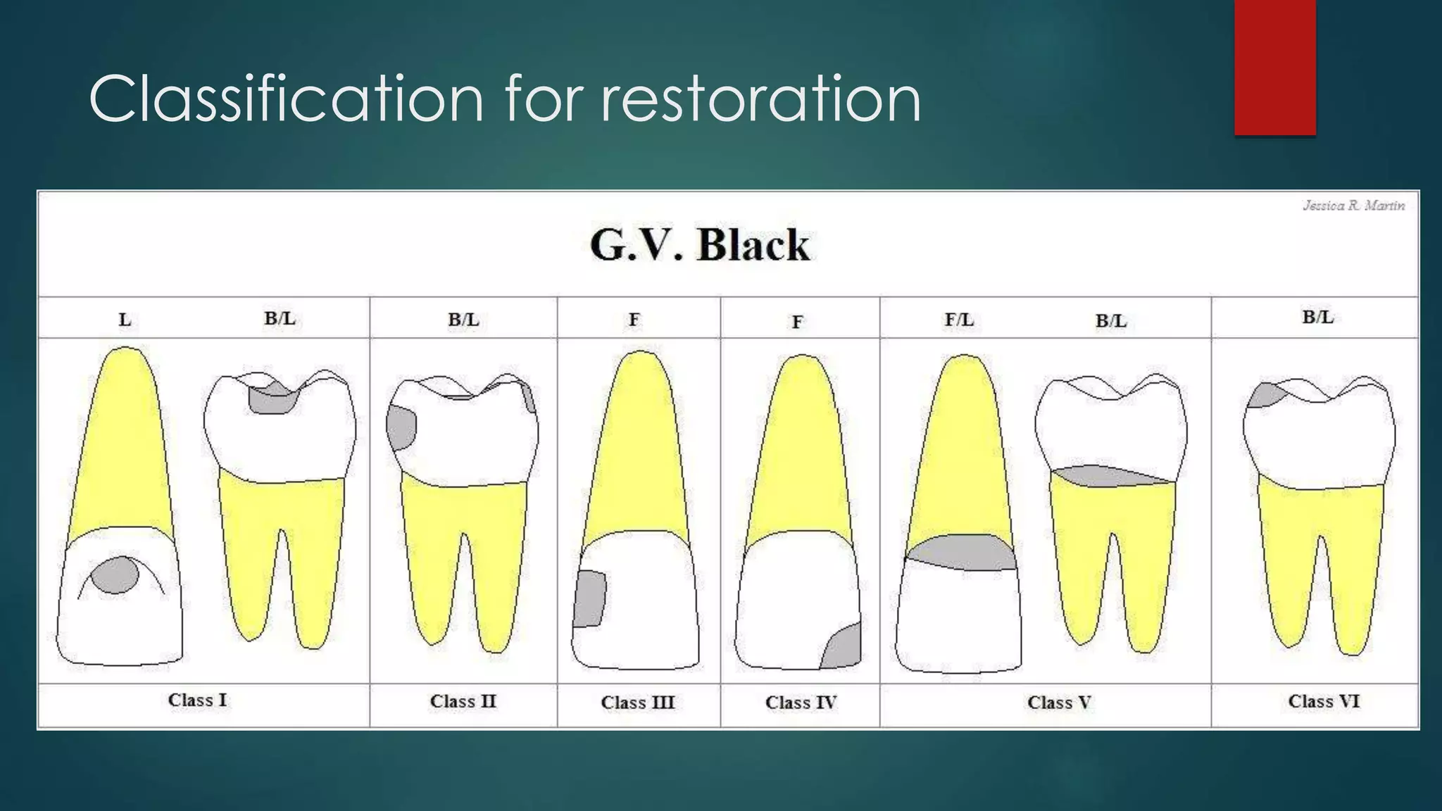 Class v tooth preparation for amalgam restorations | PPTX
