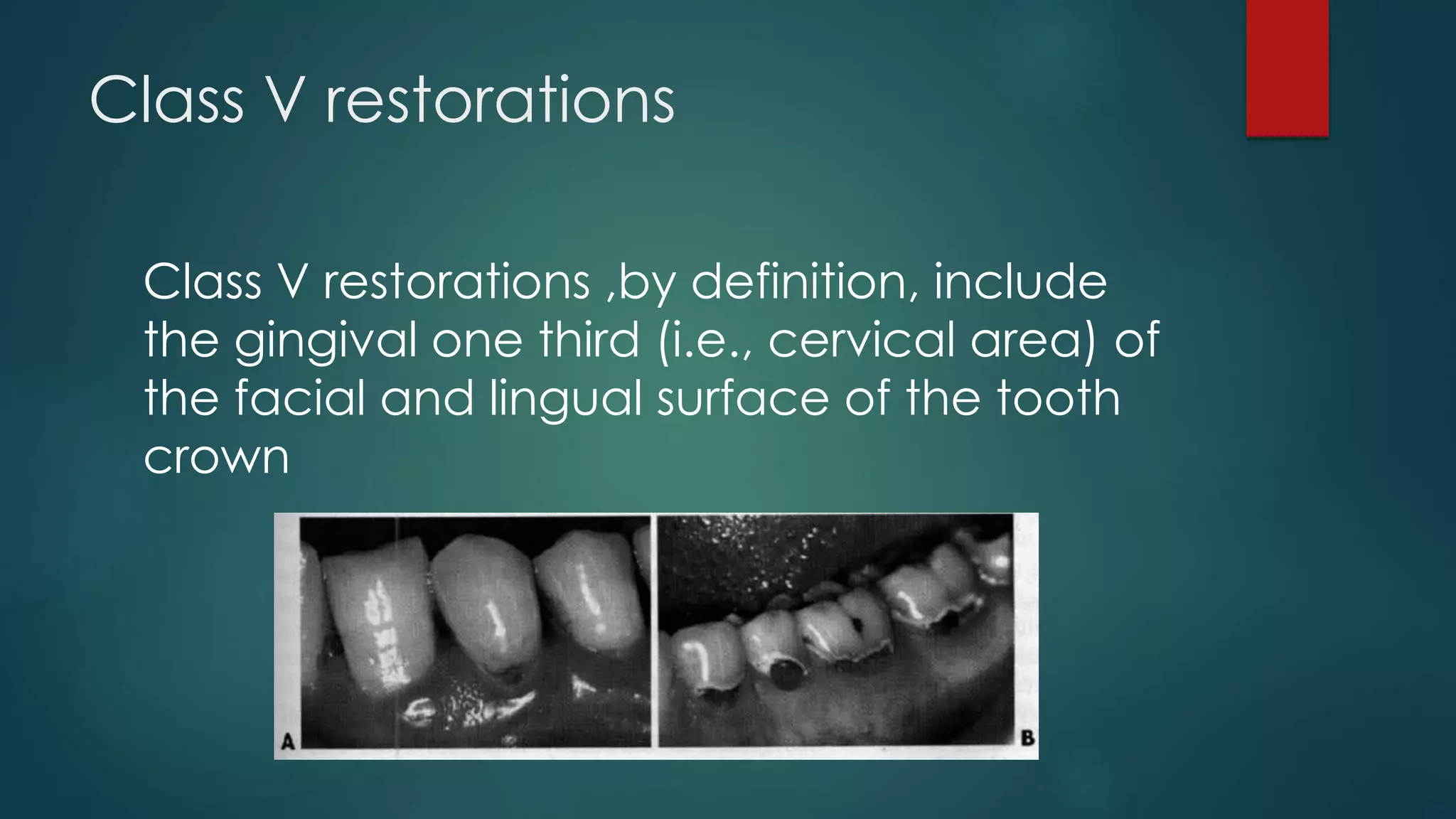 Class v tooth preparation for amalgam restorations | PPTX