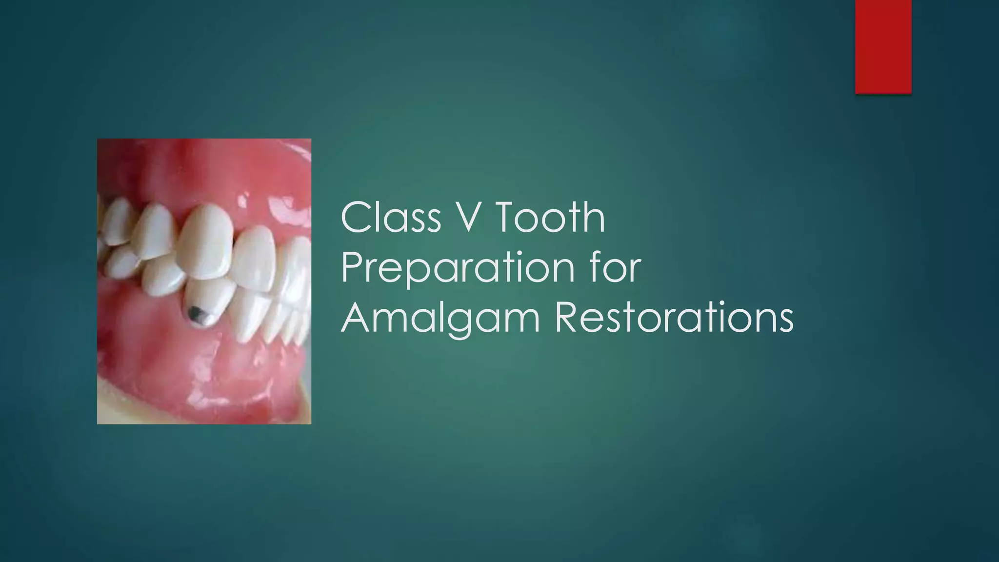 Class v tooth preparation for amalgam restorations | PPTX