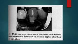 Class v tooth preparation for amalgam restorations | PPTX