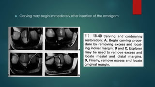 Class v tooth preparation for amalgam restorations | PPTX