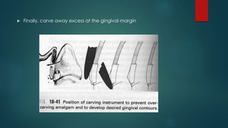 Class v tooth preparation for amalgam restorations | PPTX
