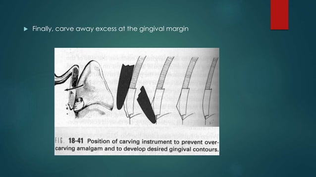 Class v tooth preparation for amalgam restorations | PPTX