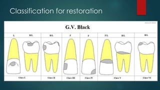 Class v tooth preparation for amalgam restorations | PPTX