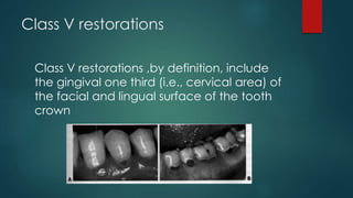 Class v tooth preparation for amalgam restorations | PPTX