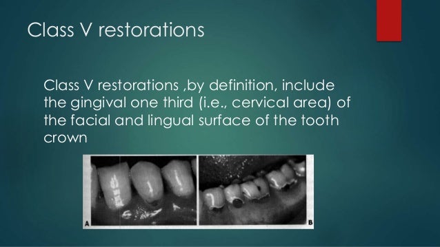 Class v tooth preparation for amalgam restorations