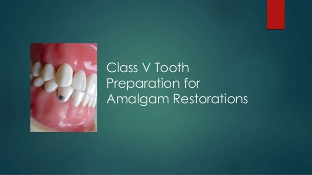 Class v tooth preparation for amalgam restorations