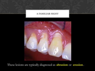 Class V Lesions | PPTX | Dental Health | Diseases and Conditions