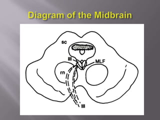 Claudes syndrome | PPT