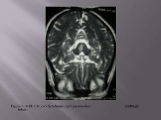 Claudes syndrome | PPT