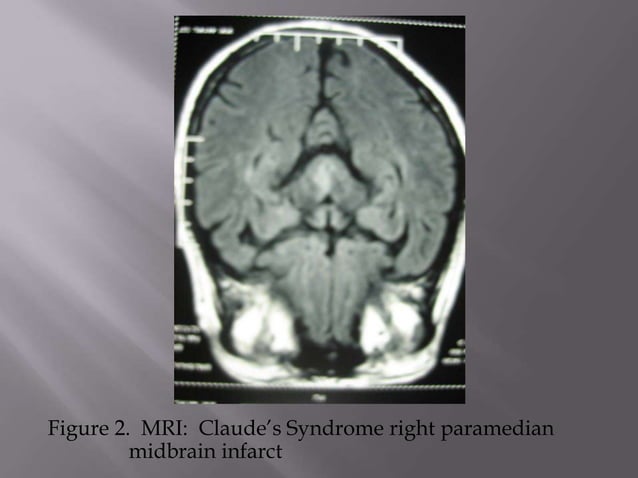 Claudes syndrome | PPT