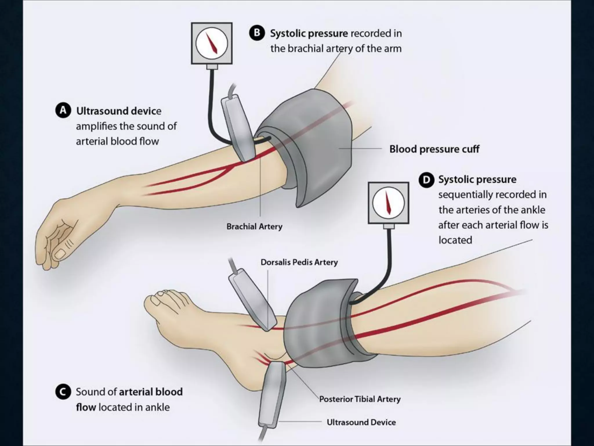 Topic of Vascular Claudication | PDF