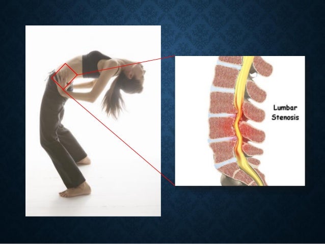 Topic of Vascular Claudication