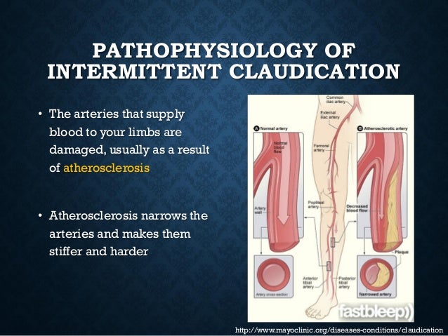 Topic of Vascular Claudication