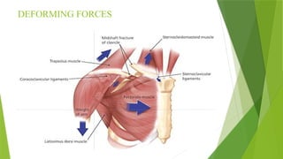 Clavical Fracture and its management orthopedics | PPTX