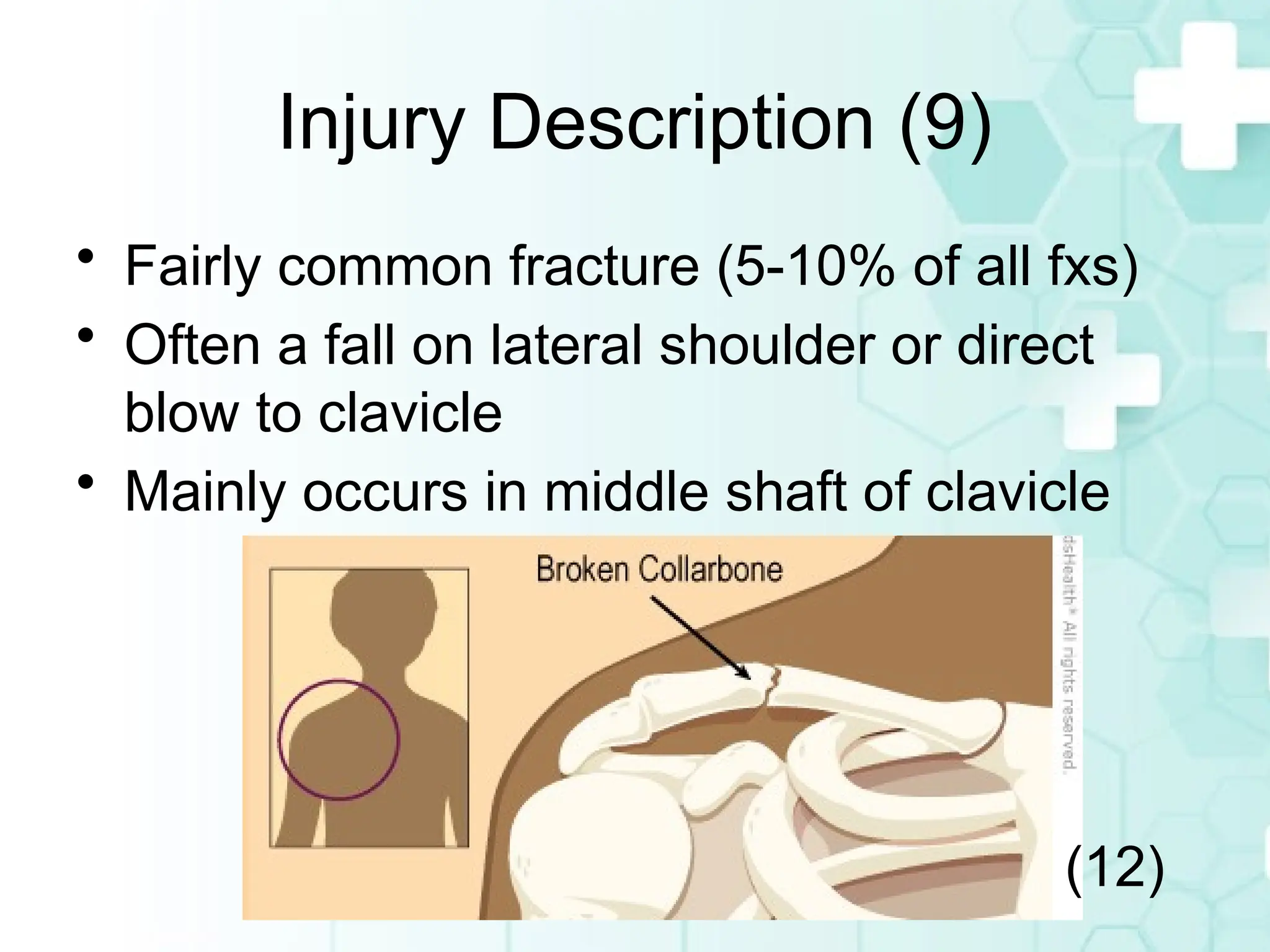 Clavical Fracture aka Broken Collarbone/ | PPTX