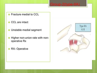 Clavicle Fracture | PPTX