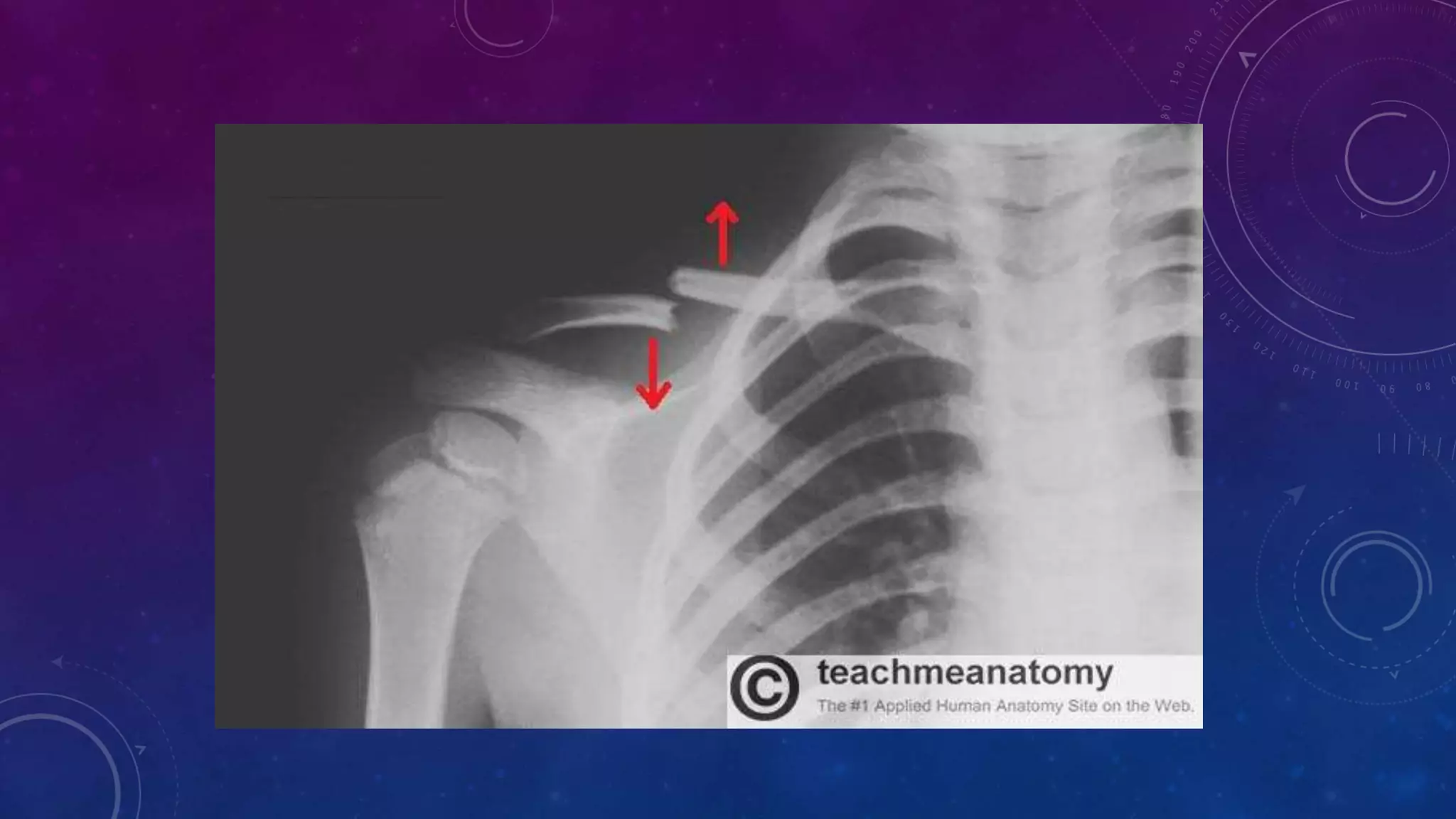 Clavicle Anatomy and its Articulation - ANAND GURMAITA (BSc. RADIOLOGY ...