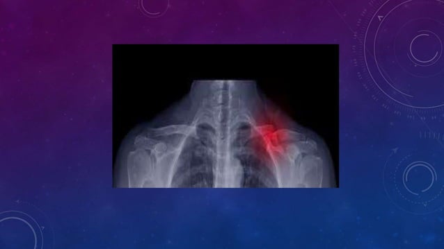 Clavicle Anatomy and its Articulation - ANAND GURMAITA (BSc. RADIOLOGY ...