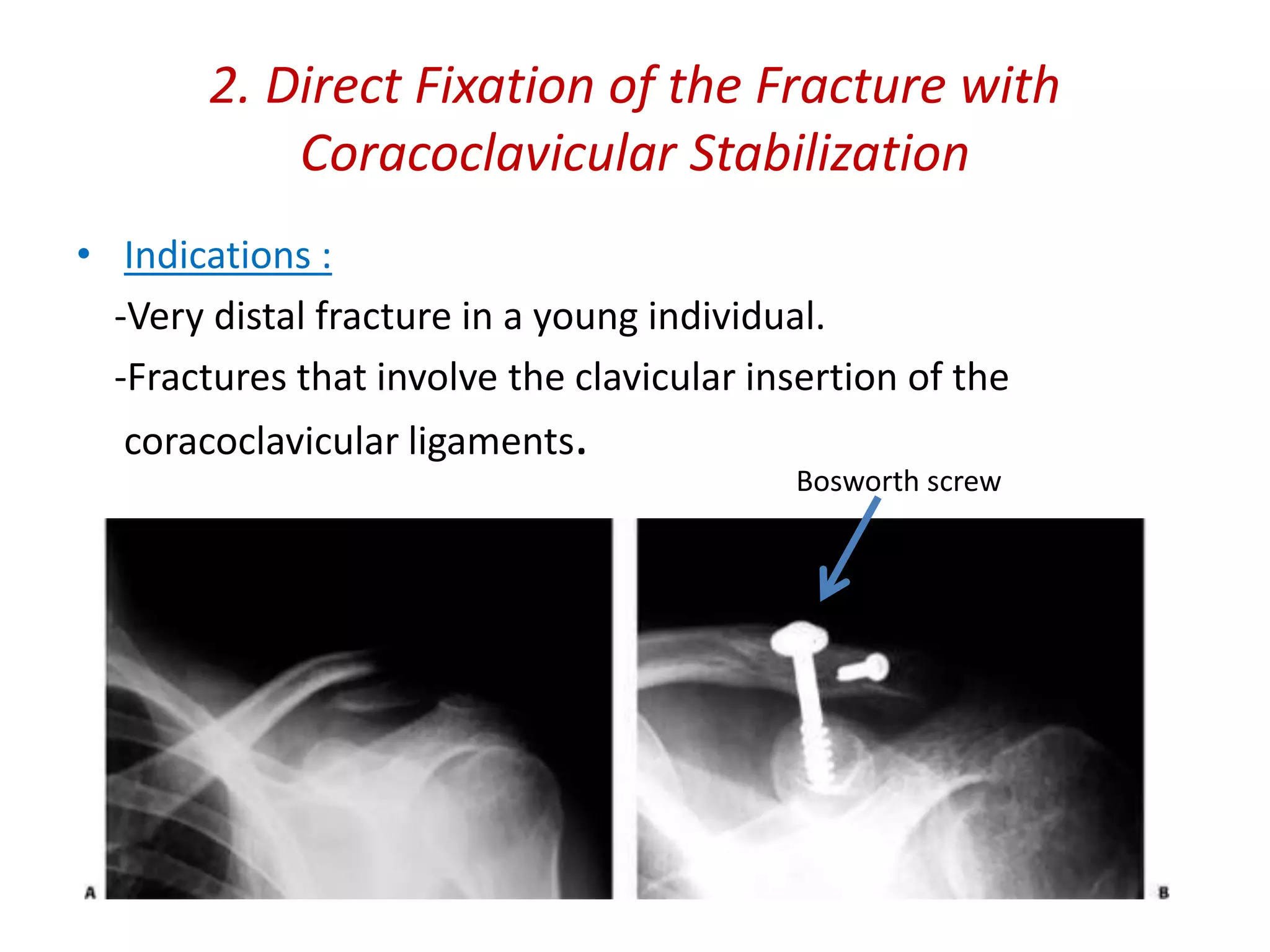Clavicle and scapular fracture | PPTX