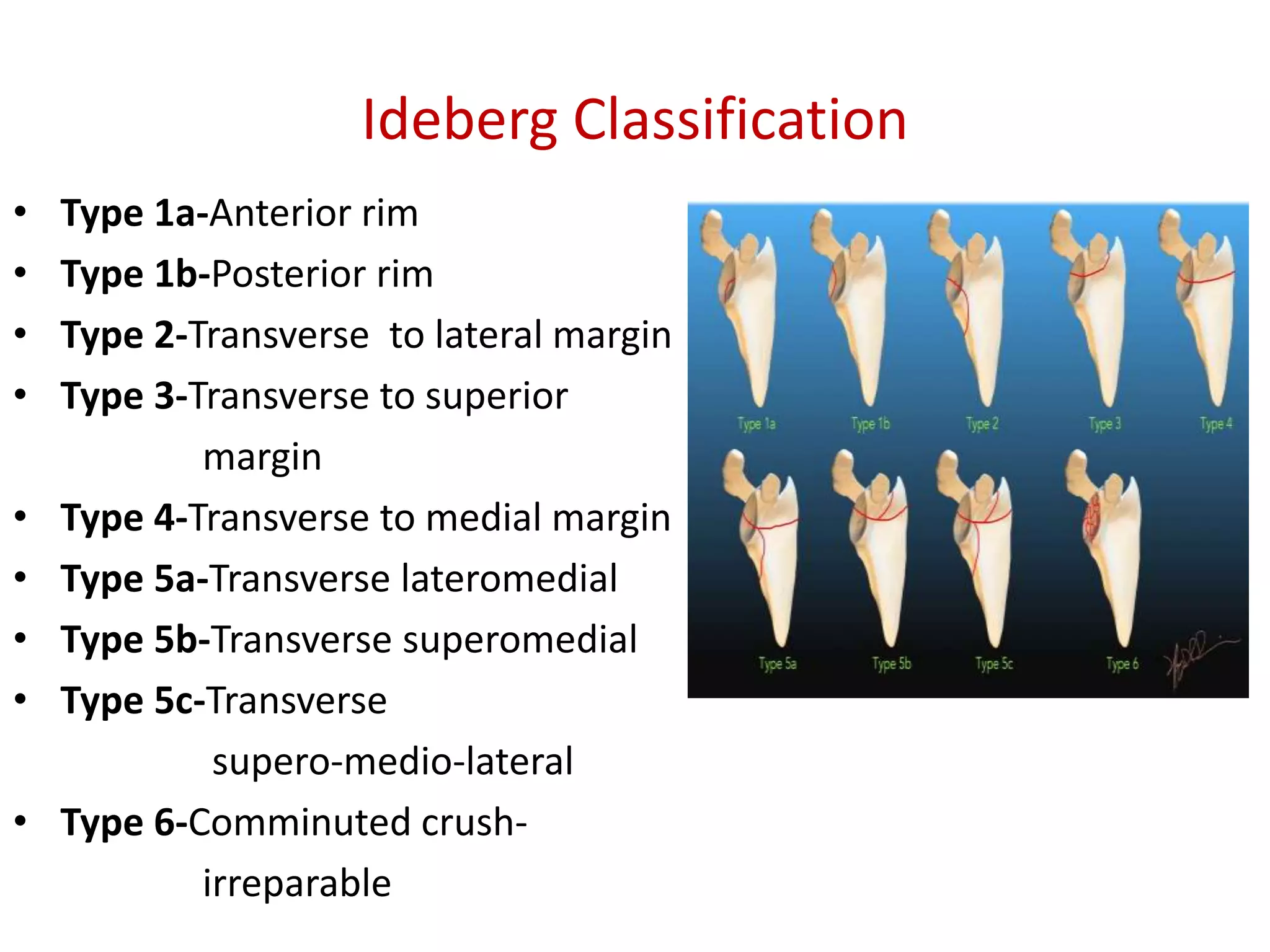 Clavicle and scapular fracture | PPTX