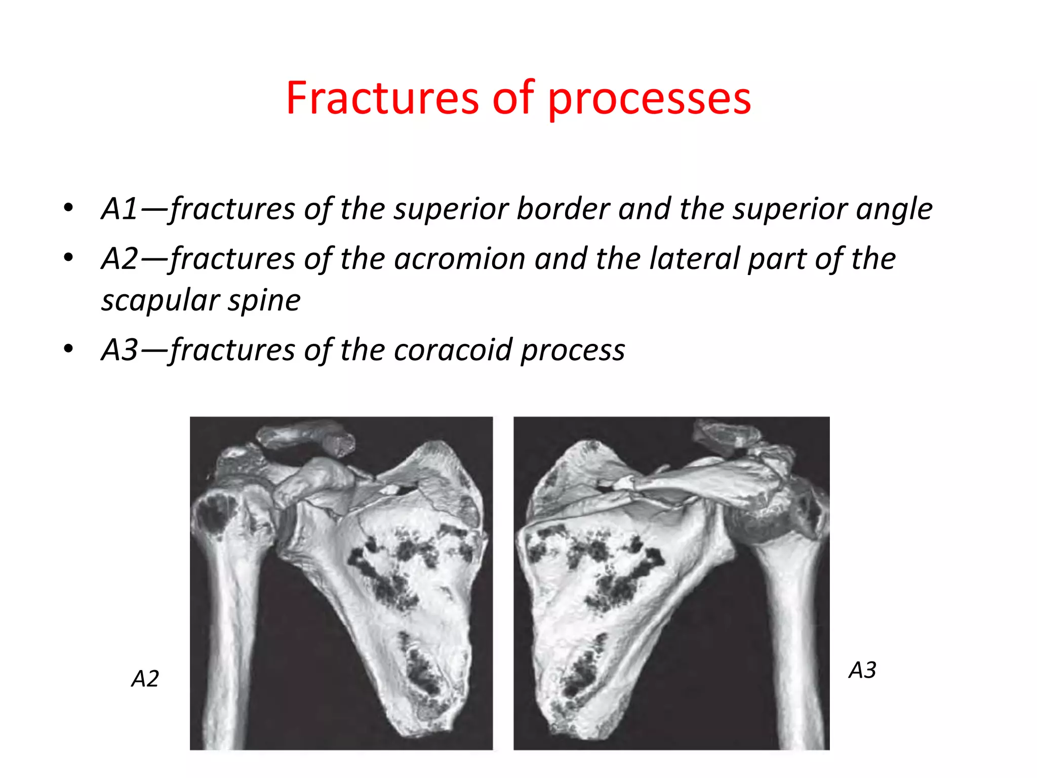 Clavicle and scapular fracture | PPTX