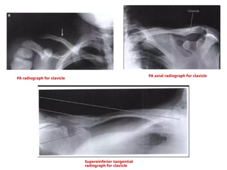 CLAVICLE, ACJ and SCJ radiographic technique.pptx