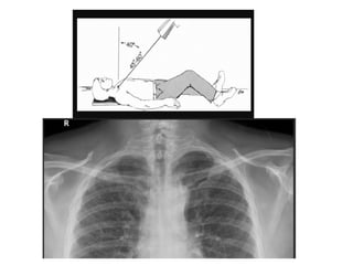 CLAVICLE, ACJ and SCJ radiographic technique.pptx
