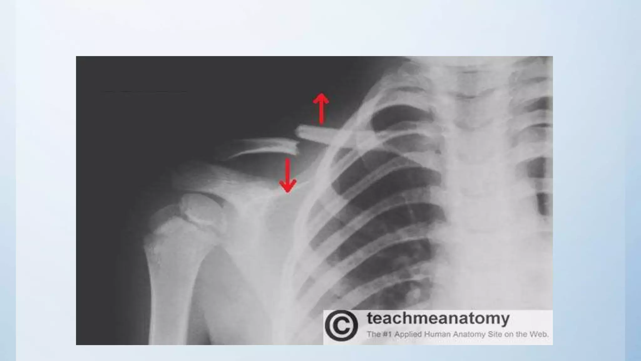 Clavicle Radiography - ANAND GURMAITA (BSc. RADIOLOGY) | PPTX