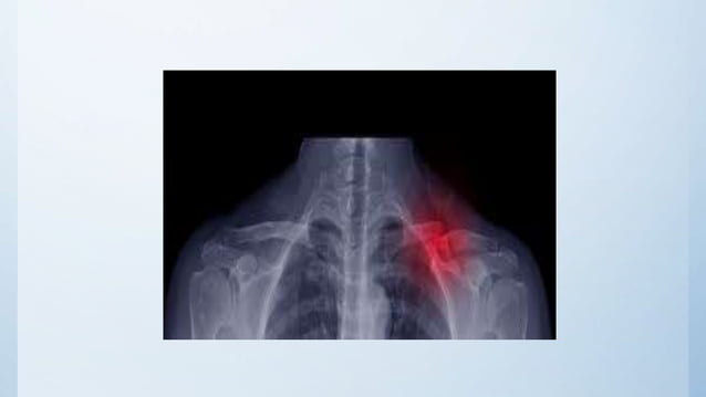 Clavicle Radiography - ANAND GURMAITA (BSc. RADIOLOGY) | PPT