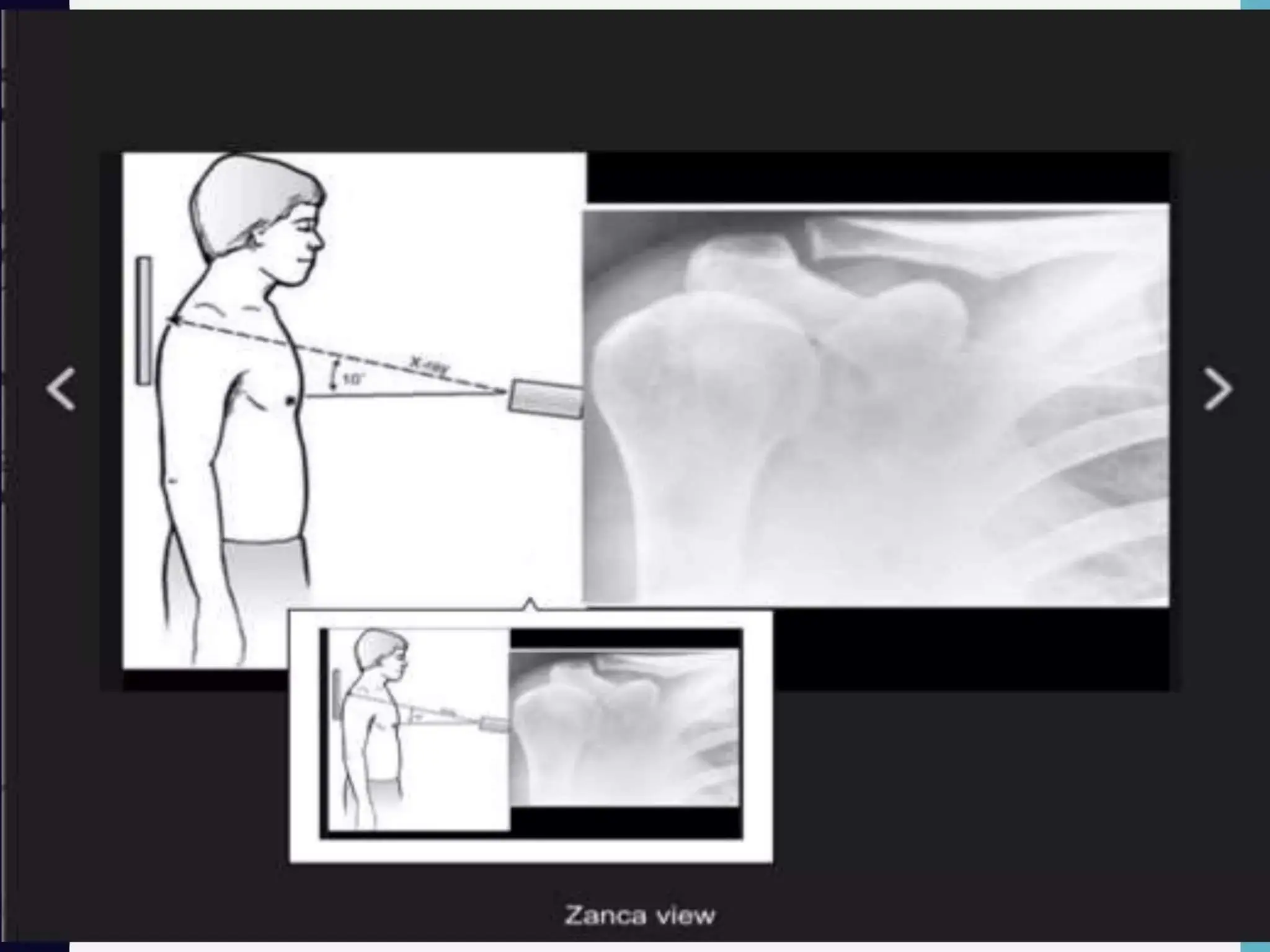 a discussion of clavicle fractures .pptx