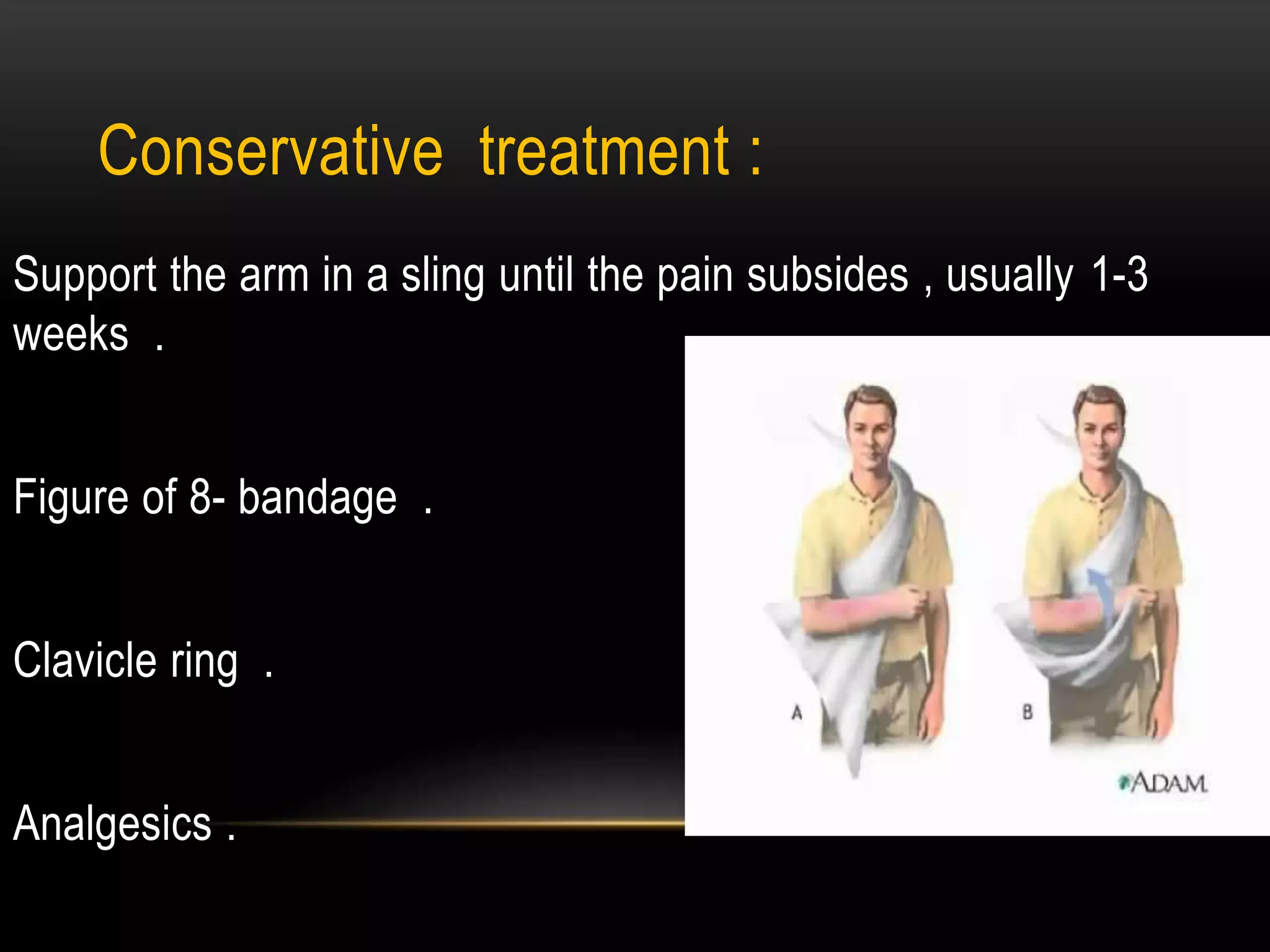 Clavicle fracture | PPTX